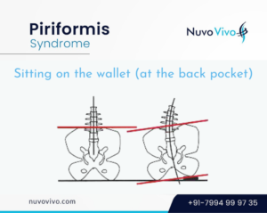Piriformis Syndrome - NuvoVivo: Reverse Your Age & Lifestyle Diseases